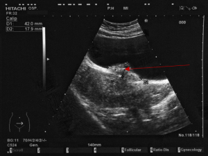 Endometriosis - Brisbane Centre for Endometriosis